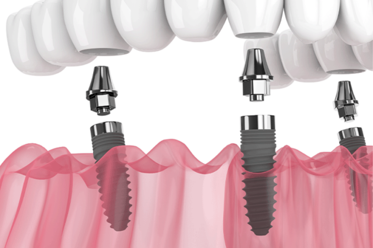 All on 4 and All on 6 Dental Implant - CLINIQUEPLUS