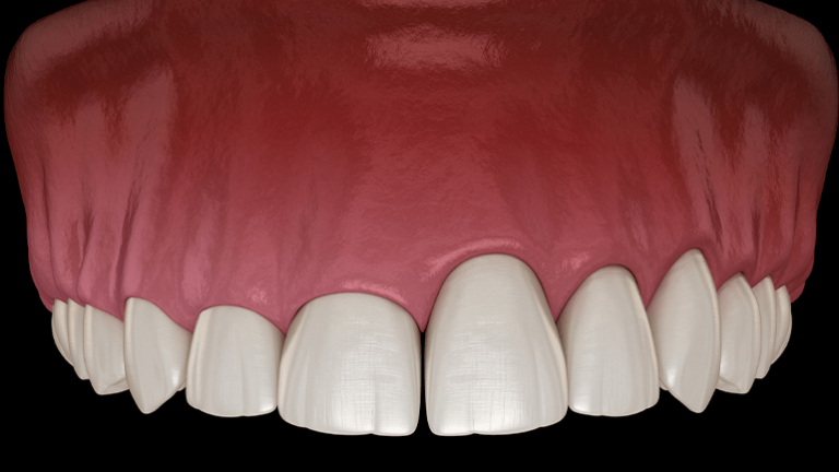 Gingivectomy: What You Need To Know? - CLINIQUEPLUS