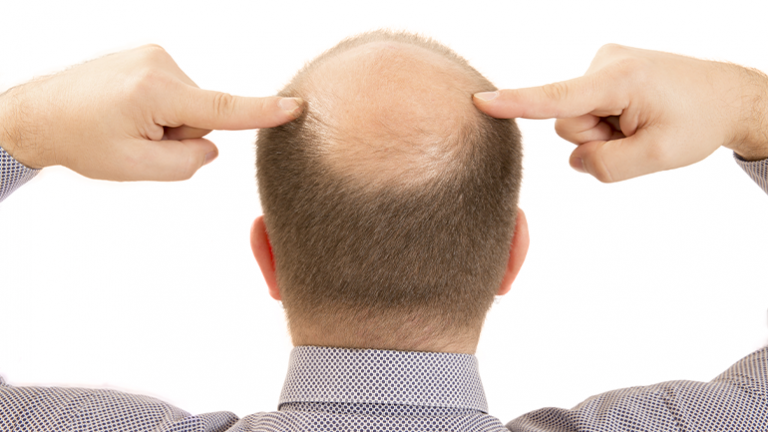 Male Pattern Baldness Genetics - CLINIQUEPLUS