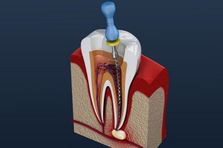 Endodontie – Traitement du Canal Radiculaire - CLINIQUEPLUS