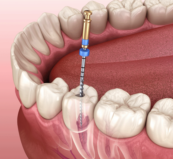 Endodontie – Traitement du Canal Radiculaire - CLINIQUEPLUS