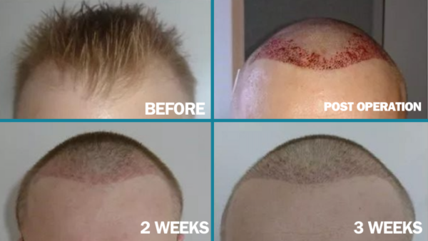 What to Expect 7 Days After Hair Transplant Surgery - CLINIQUEPLUS