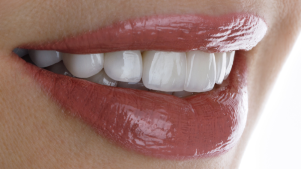 How Much Is A Full Set Of Veneers In Turkey? - CLINIQUEPLUS