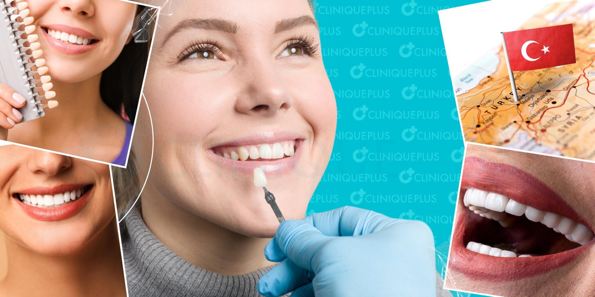 Veneers in Turkey: 2025 Cost Guide & Premium Hollywood Smile Packages - CLINIQUEPLUS