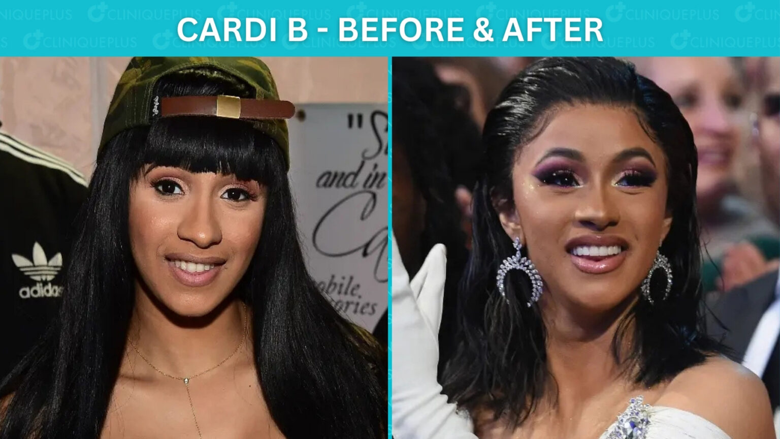 Famous Celebrity Veneers Before and After: Hollywood Smile ...