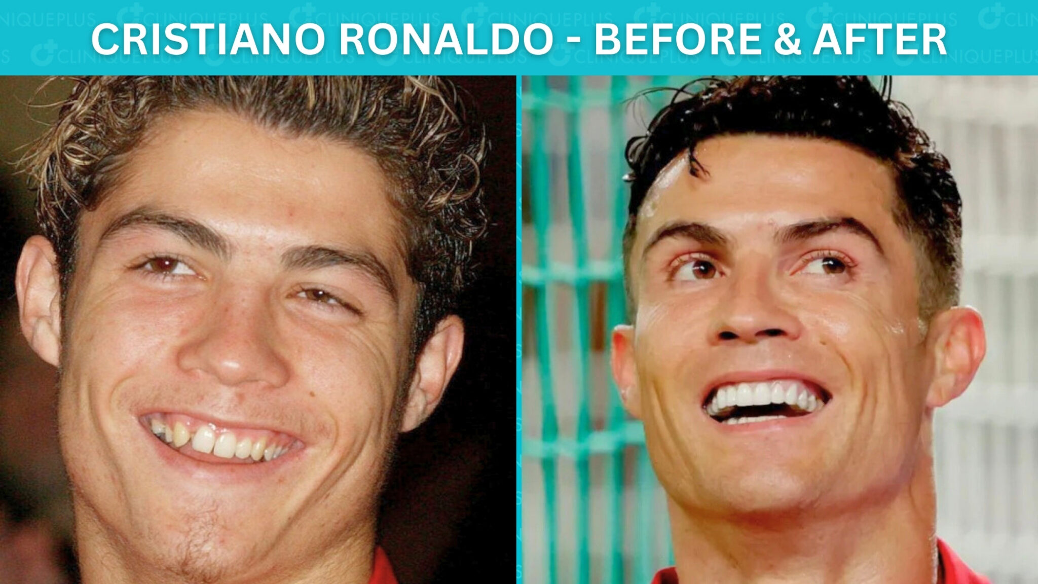 Famous Celebrity Veneers Before and After: Hollywood Smile ...