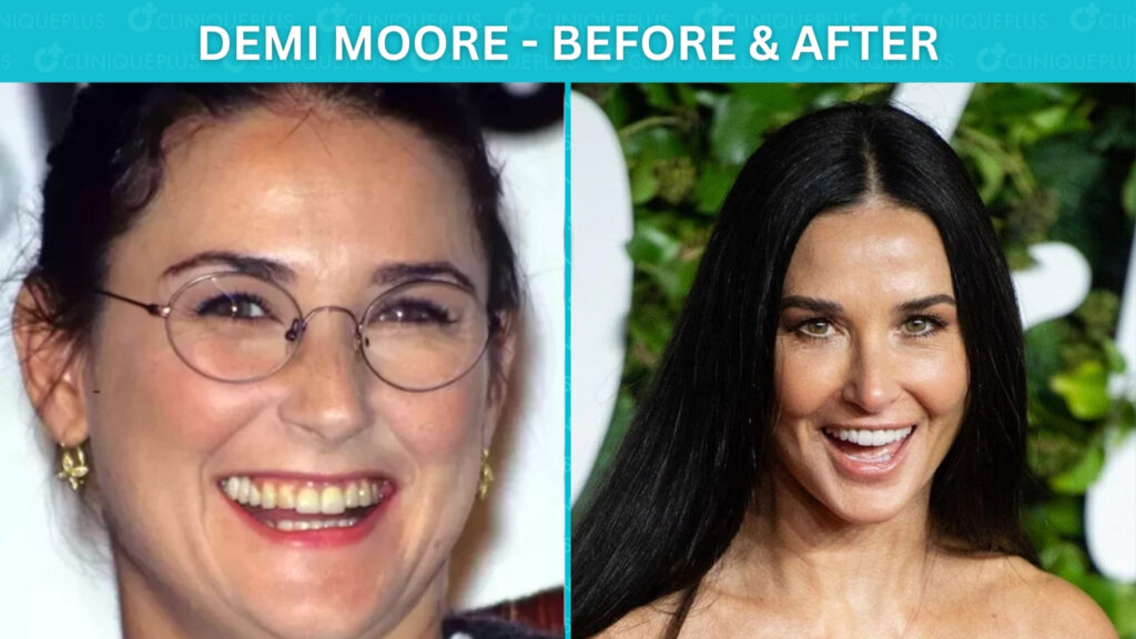 Famous Celebrity Veneers Before and After: Hollywood Smile ...