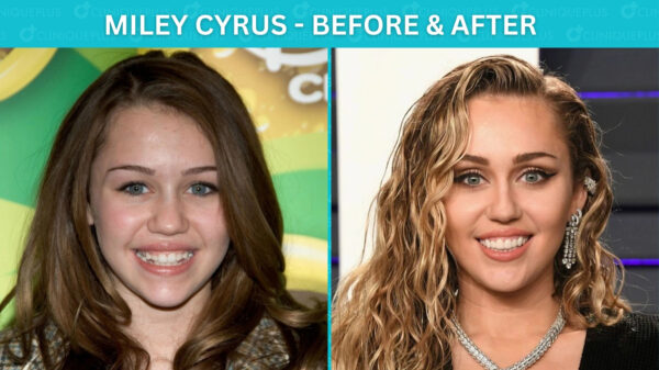 Famous Celebrity Veneers Before and After: Hollywood Smile ...