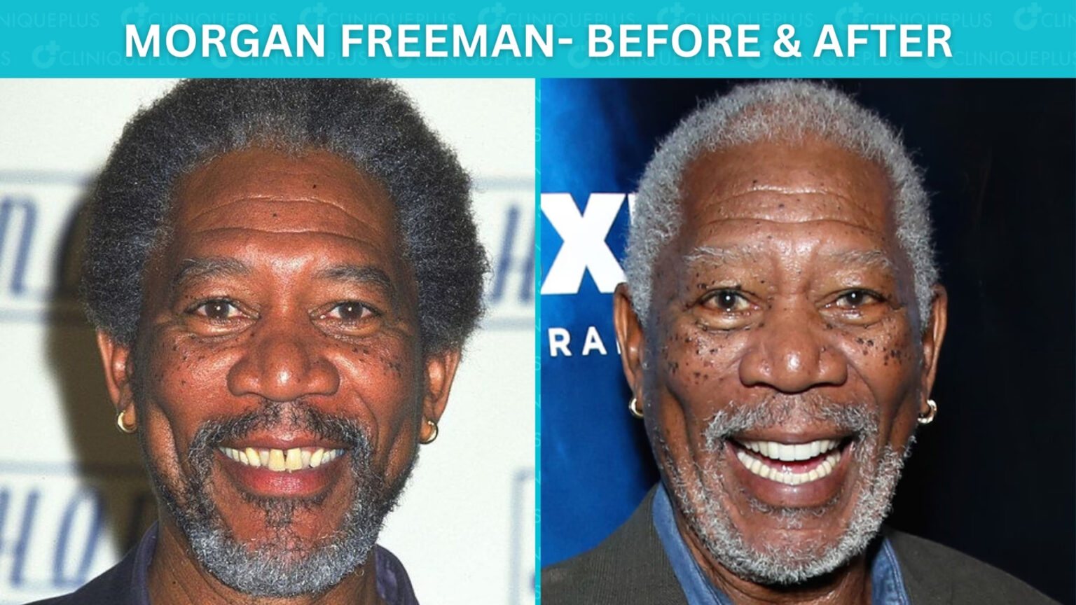 Famous Celebrity Veneers Before and After: Hollywood Smile ...