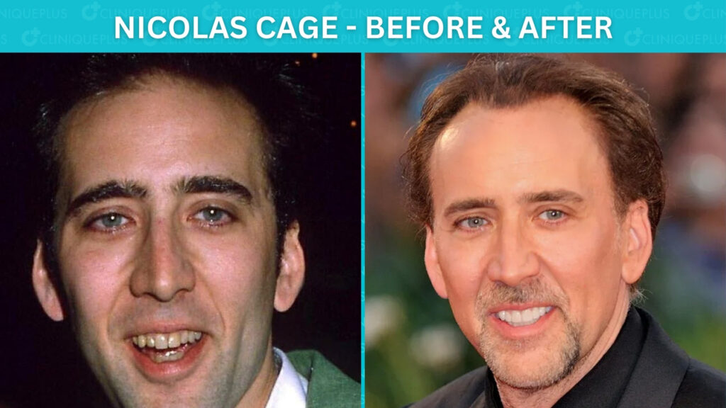 Famous Celebrity Veneers Before and After: Hollywood Smile ...