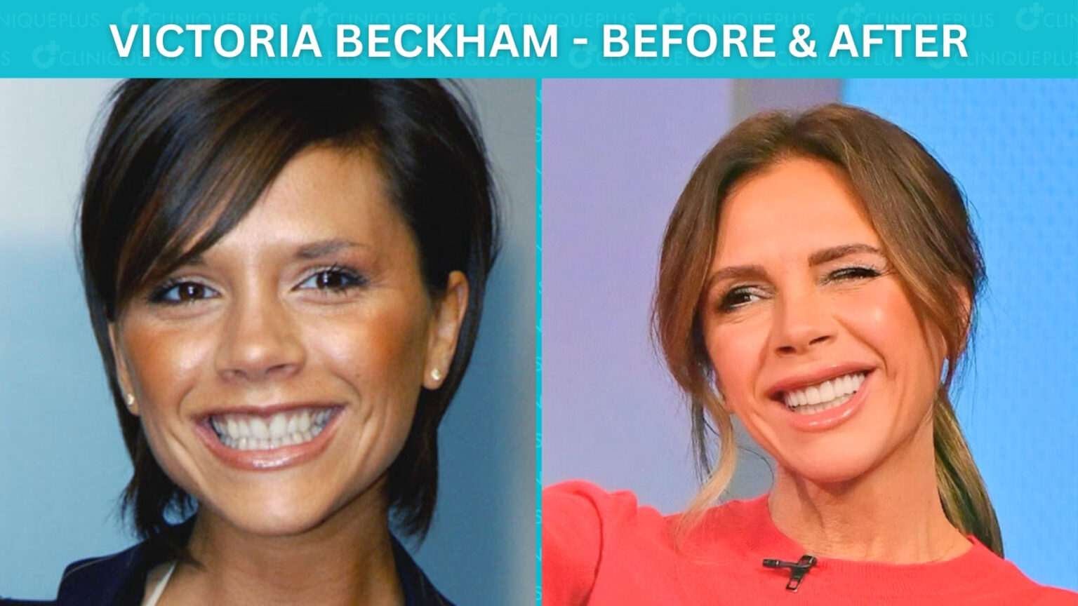 Famous Celebrity Veneers Before and After: Hollywood Smile ...